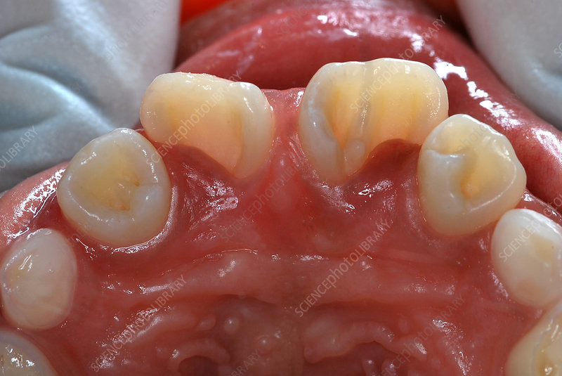 What Is Dens In Dente? - My BEST Dentists Journal - MyBestDentists