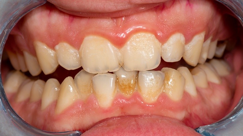 Dental Biofilm and Oral Health Issues - My BEST Dentists Journal ...