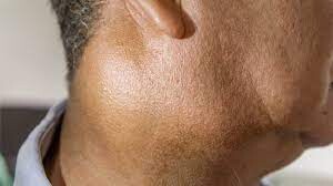 What Causes Submandibular Gland Swelling? - My BEST Dentists Journal ...