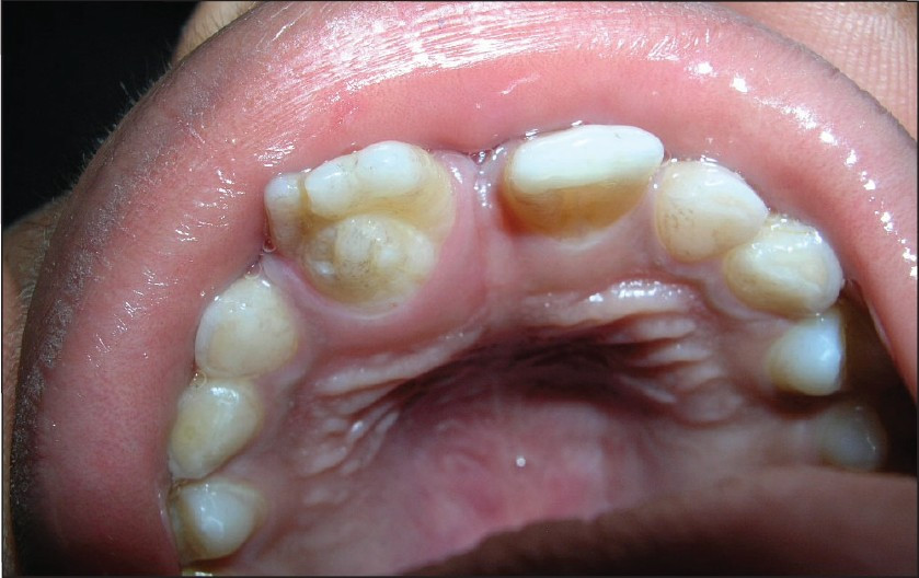 What Is Dens In Dente? - My BEST Dentists Journal - MyBestDentists
