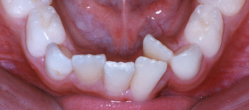 7 Most Common Bite Problems in Children and Adults - My BEST Dentists ...