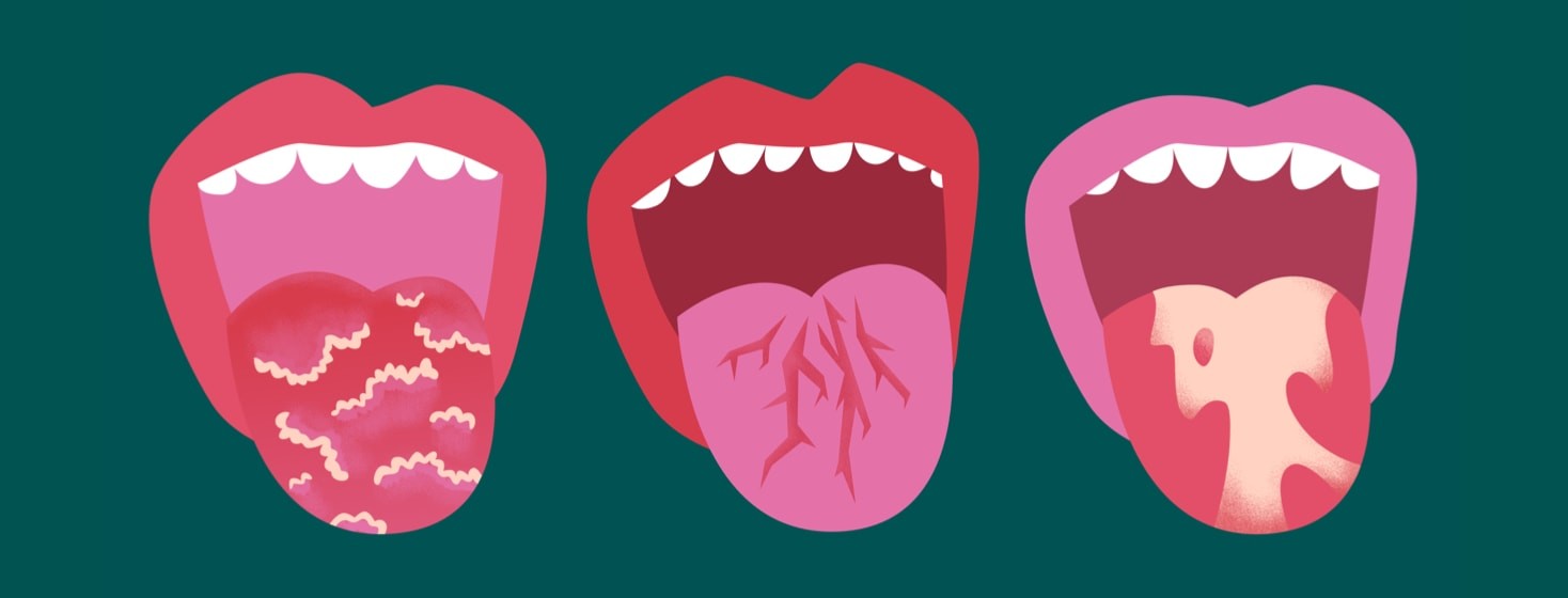 What Is Oral Psoriasis? - My BEST Dentists Journal - MyBestDentists