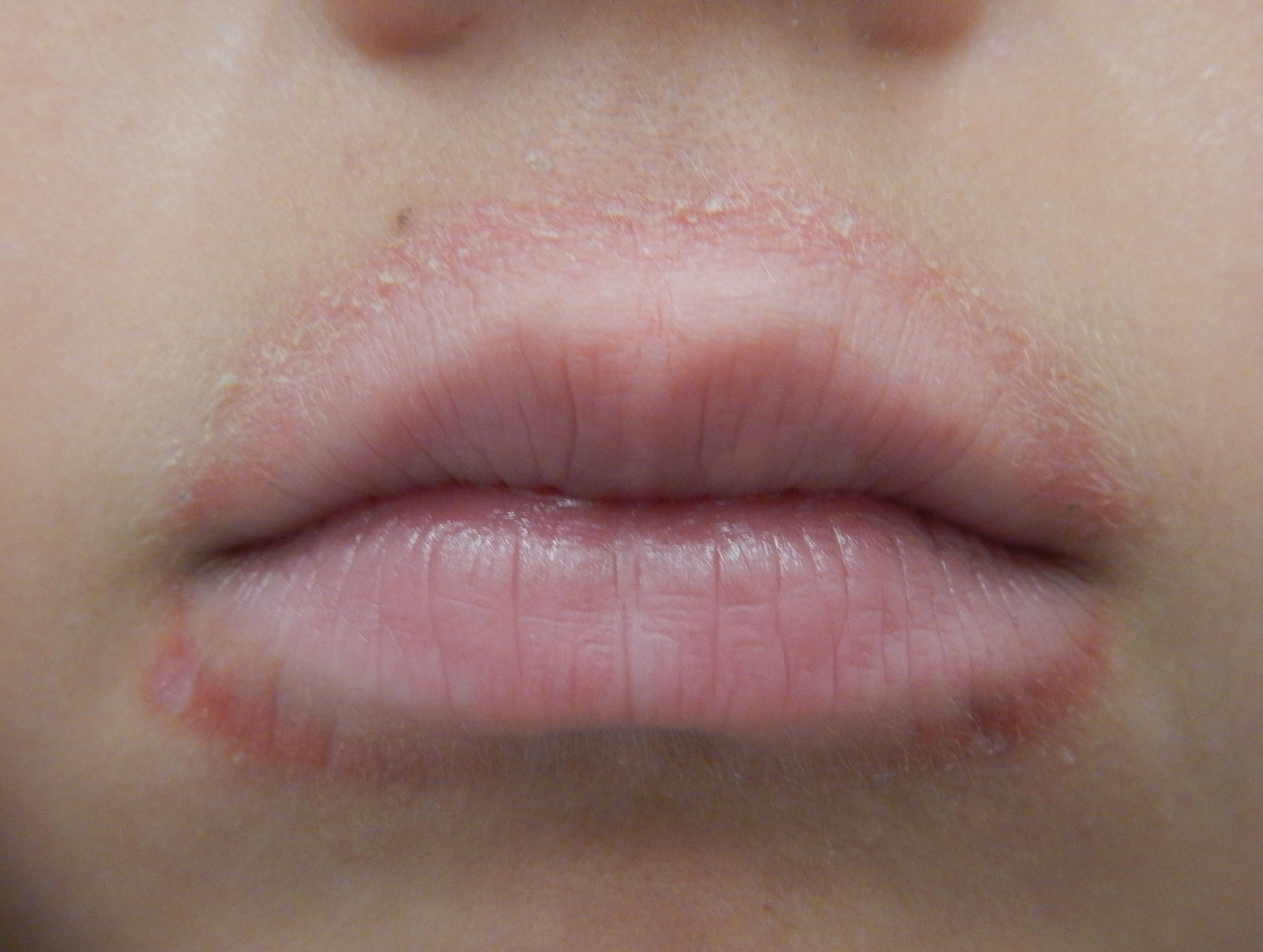 Perioral Dermatitis Symptoms Causes And Treatment My Best Dentists