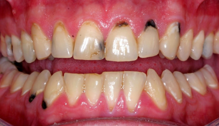 How to treat and prevent gum line cavities - My BEST Dentists Journal ...