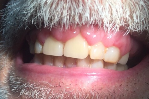What is gingival hyperplasia? - My BEST Dentists Journal - MyBestDentists