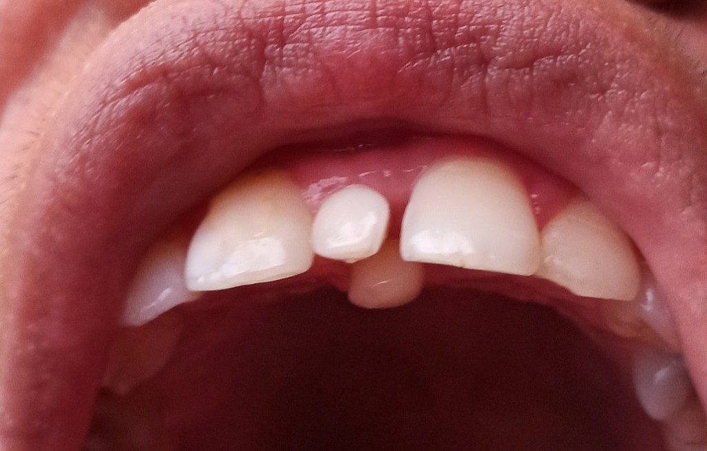 Adult with baby teeth: causes and treatments - My BEST Dentists Journal ...