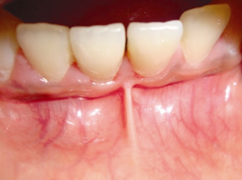 Frenulum In The Mouth - My BEST Dentists Journal - MyBestDentists